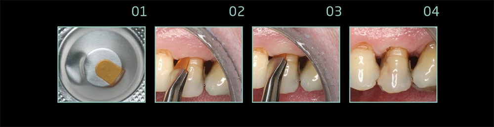 PerioChip - 1 2 3 4 - Lawton Dental Care